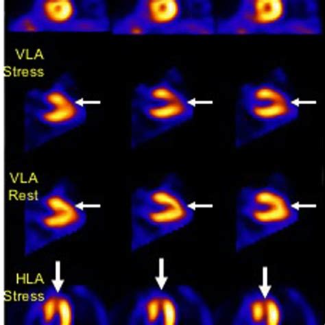 SPECT Myocardial Perfusion Imaging At Rest And In Response To Download Scientific Diagram