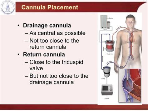 Cannulation And Recirculation In Vv Ecmo Pptx