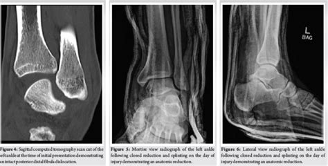 A Rare Bosworth Variant Isolated Distal Fibula Dislocation With A