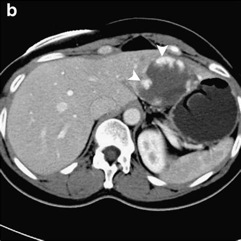 Nodular Regenerative Hyperplasia In A 77 Year Old Male With 30year