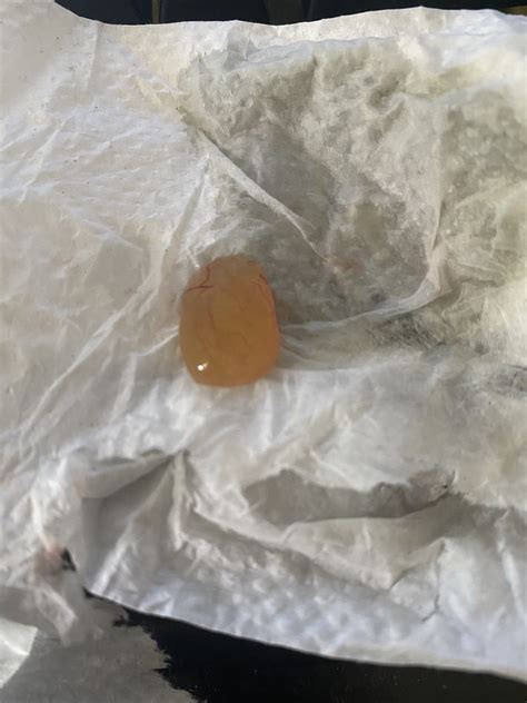 Had Nasal Polyp Surgery For “the Most Extreme Case Ive Ever Seen My Surgeon He Put My On