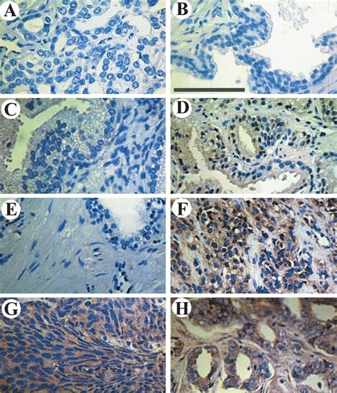 Ilk Immunostaining Of Bph And Cap Representative Immunostained
