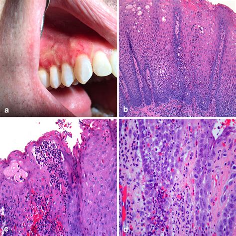 Pyostomatitis Vegetans A Irregular Linear “snail” Tracts Along The Download Scientific Diagram