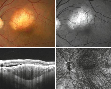 Swept Source Oct Of Choroidal Nevi Ento Key