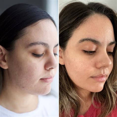 Retinol Before And After Transform Your Skin With These Results Must