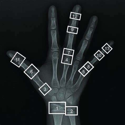 Correlation Coefficients Between Mandibular Plane Angle Smi Tw3 Bone Download Scientific