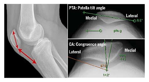 Patellofemoral Pain Syndrome د عبد الحميد سيد عيسى