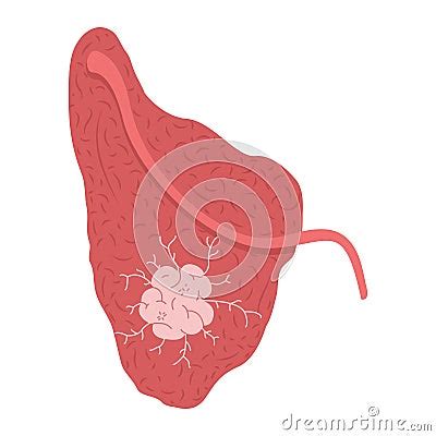 A Tumor On The Parotid Salivary Gland Cartoon Vector CartoonDealer