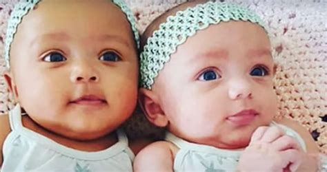 Interesting Story A Woman Gave Birth To Twins With Different Skin