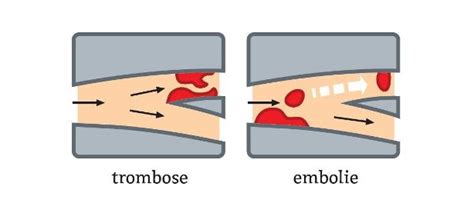 Embolie Een Gevaarlijke Reis Van Bloedstolsels