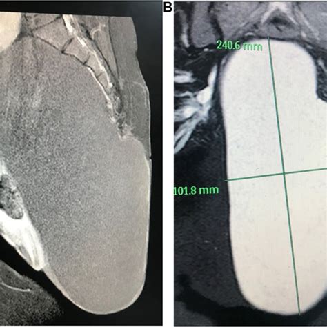 Pdf A Giant Sacrococcygeal Teratoma In Adult Female A Case Report