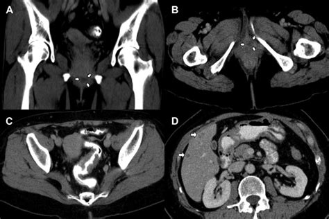 CT Scan Images For The Lesions A B Pelvic Computed Tomography CT Download Scientific
