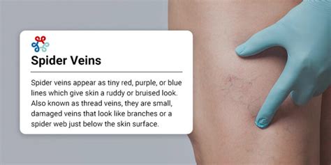 Spider Veins And Varicose Veins Whats The Difference Vein Care