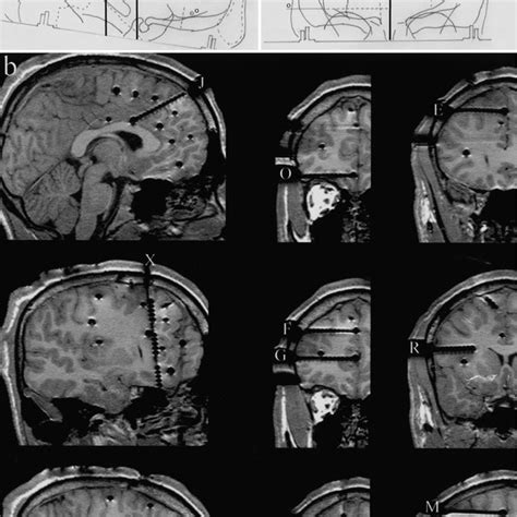 Localization Of The Epileptogenic Zone As Revealed By Download Table