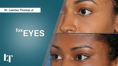 Fox Eyes Youtube