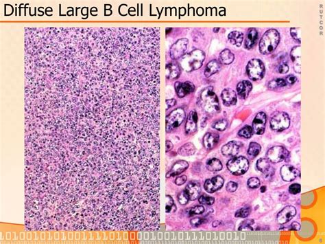 Ppt Logical Analysis Of Diffuse Large B Cell Lymphoma A Versatile