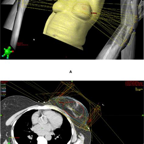 Beam Configuration A And Dosimetry B For A APBI Case Treated With