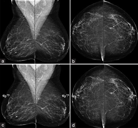 Cad May Not Be Necessary For Microcalcifications In The Digital Era