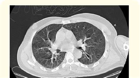 Axial View Of Thoracic Ct Scans Lung Window No Ground Glass Opacity