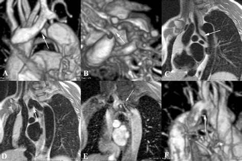 Patient With Left Aortic Arch And Right Descent And Persistent