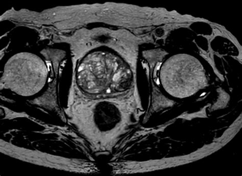 Multi Phase Contrast Enhanced Prostate Imaging Philips Mr Body Map