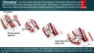 Thoracotomy Incision Ppt By Dr Amrit Kumar Pptx