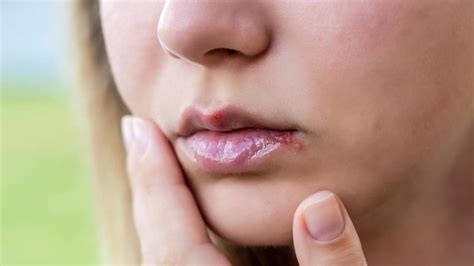 The Correct Dosage Valtrex And Valacyclovir Dosage For Cold Sores