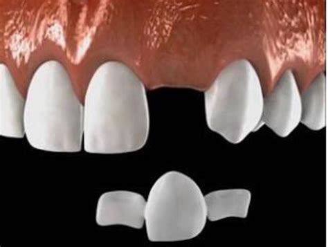 Reabilitação oral Clermont Odontologia
