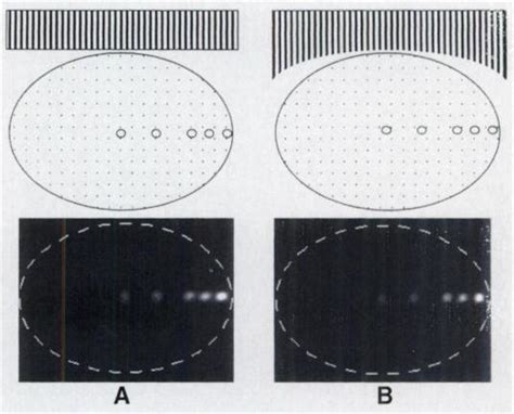 Spatial Resolutionassessed By Simulated Spect Data With Three