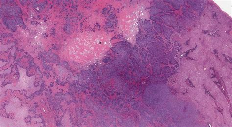 Cholangiocarcinoma Atlas Of Pathology