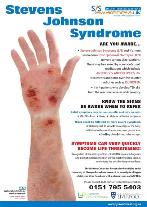 Stevens Johnson Syndrome What Is It 48 Off