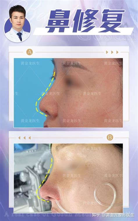 鼻尖没做好，隆鼻等于白花钱了？ 知乎