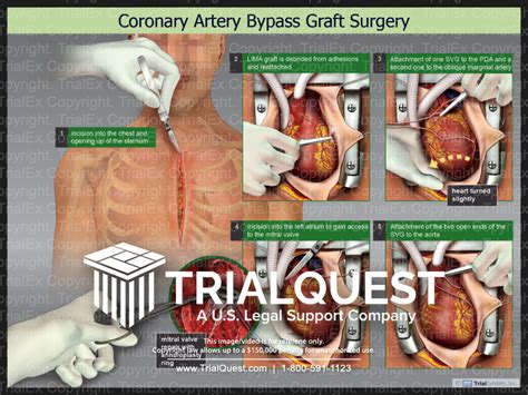 Coronary Artery Bypass Graft Surgry