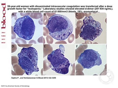 Chediak Higashilike Granules Within Leukemic Promyelocytes