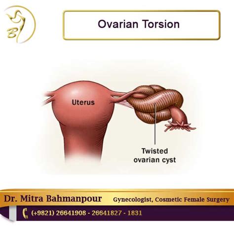 Ovarian Torsion Ovarian Torsion Causes Ovarian Torsion Symptoms