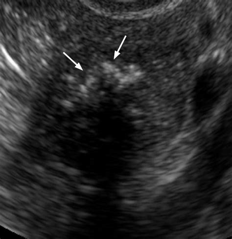Brenner Tumor In A 49 Year Old Woman Transvaginal Ultrasonography