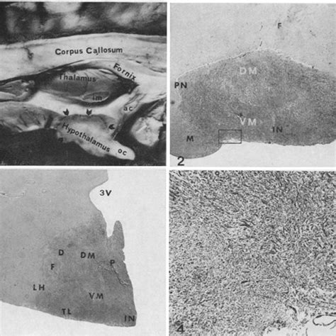Lesions Of The Hypothalamic Nuclei In The Case Reported Download Table