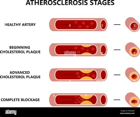 Atherosclerosis Plaque Development