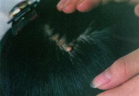 皮样囊肿 中国皮肤性病彩色图谱