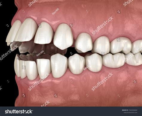 Malocclusion Stock Illustrations Images And Vectors Shutterstock