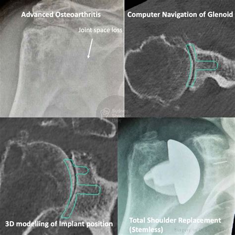 Shoulder Joint Arthritis Dr Pant Sydney Shoulder Unit