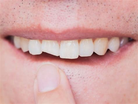 ¿qué Hacer Ante Un Traumatismo Dentario Cora Odontología