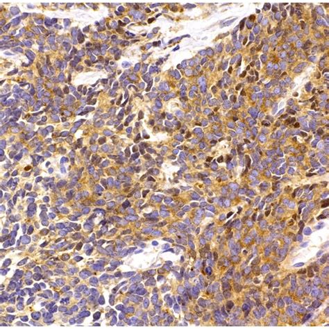 Prostate Cancer Displaying Universal Neuroendocrine Differentiation