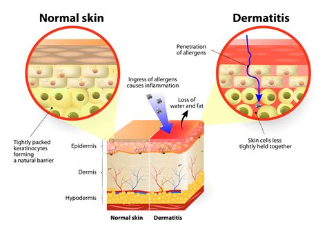 Dealing With Eczema Amore Mi