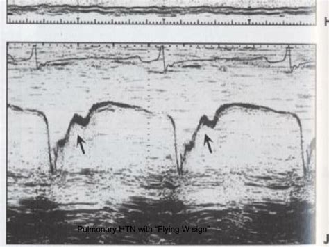 Ppt M Mode Echocardiography Powerpoint Presentation Free Download