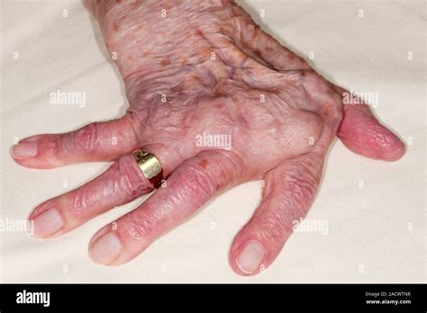 Arthritic Hand Of A 93 Year Old Female Patient With Rheumatoid