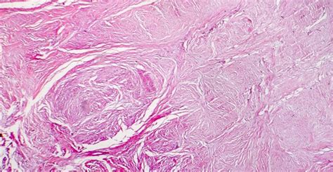 Phimosis And Paraphimosis Uci Pediatric Urology