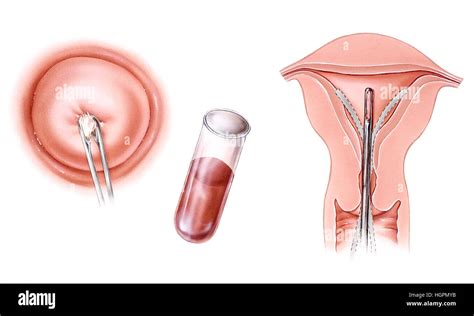 Postcoital Test Hi Res Stock Photography And Images Alamy