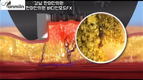 한미인의원 바디인모드fx Youtube