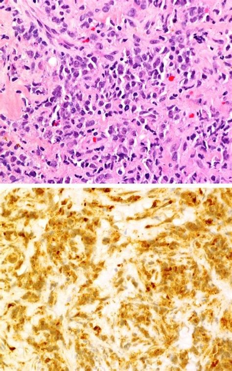 Biopsy Of Soft Tissue Near The Left Knee Demonstrates An Infiltrate Of